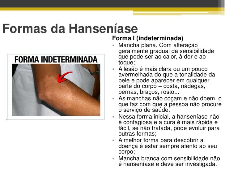 Hanseniase