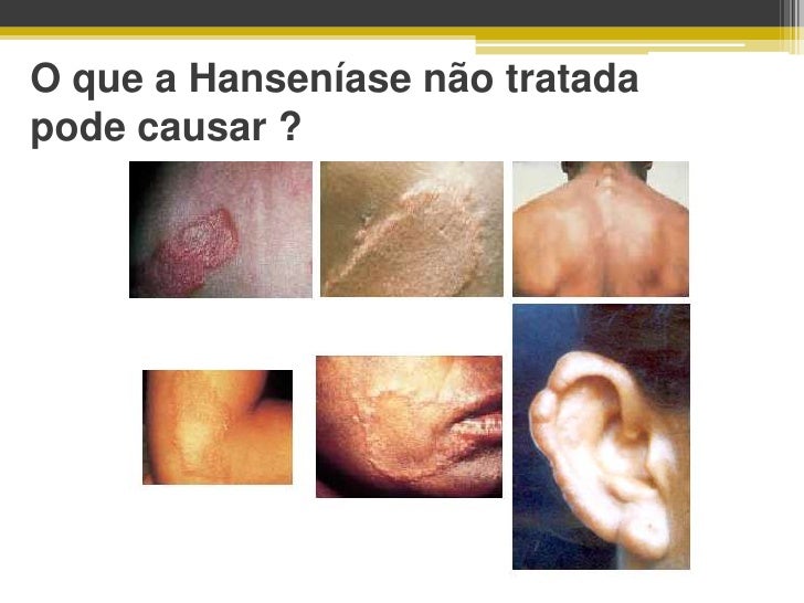 Hanseniase