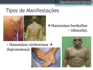 Hanseniase mycobacteruim leprae | PPTX