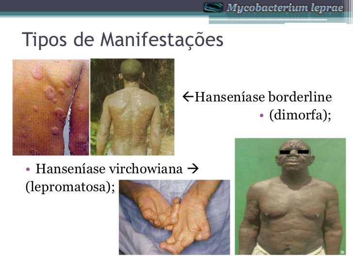 Hanseniase mycobacteruim leprae
