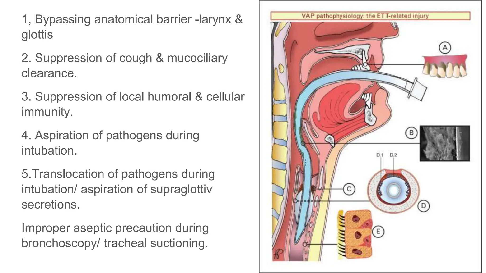 Hospital Acquired Pneumonia-Ventilator Associated Pneumonia | PPTX