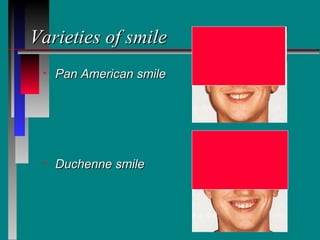 Duchenne Smile Vs Pan Am Smile