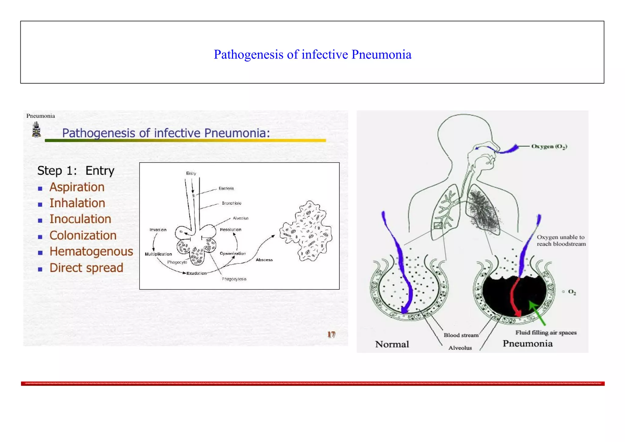 Hospital Acquired Pneumonia | PDF