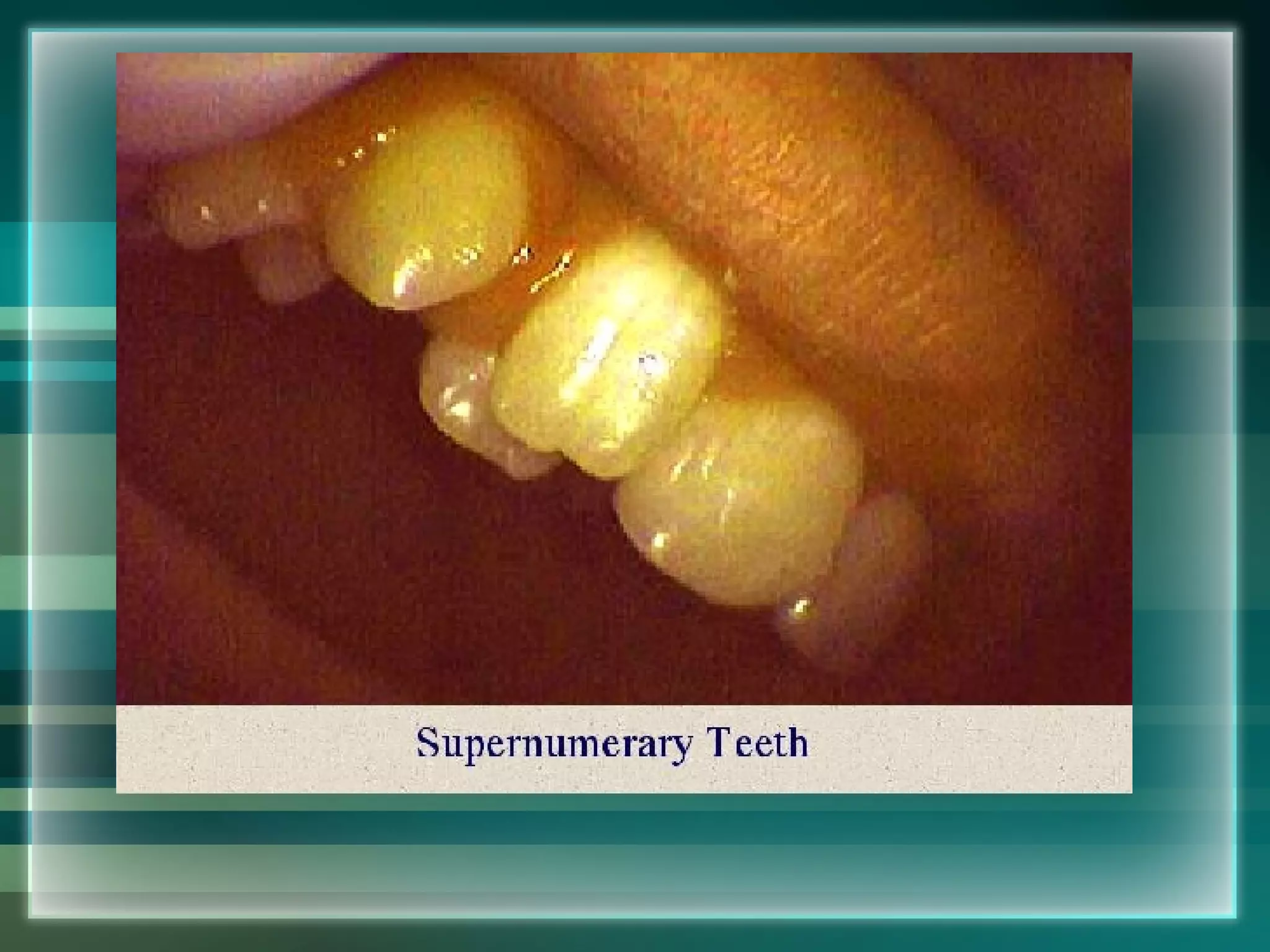 Hard Tissue Charting | PPT