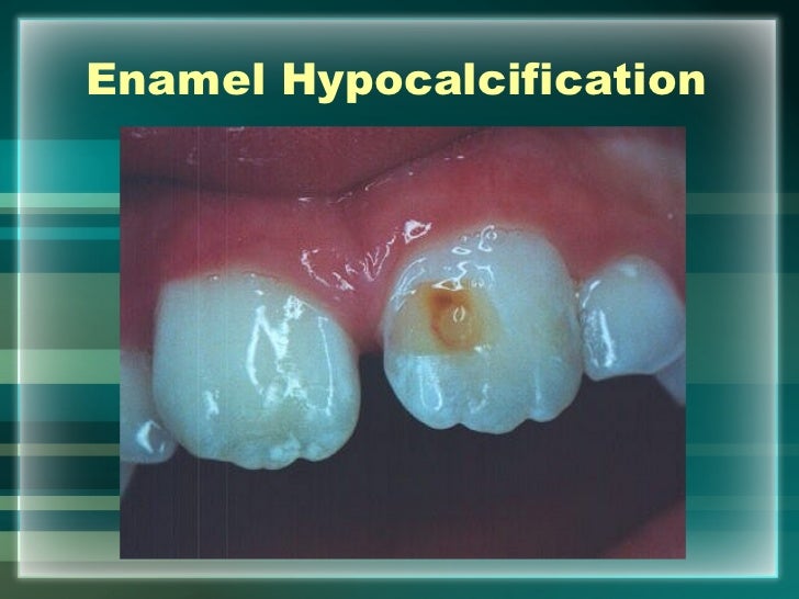 Enamel Hypocalcification Vs Enamel Hypoplasia Figure 1 From