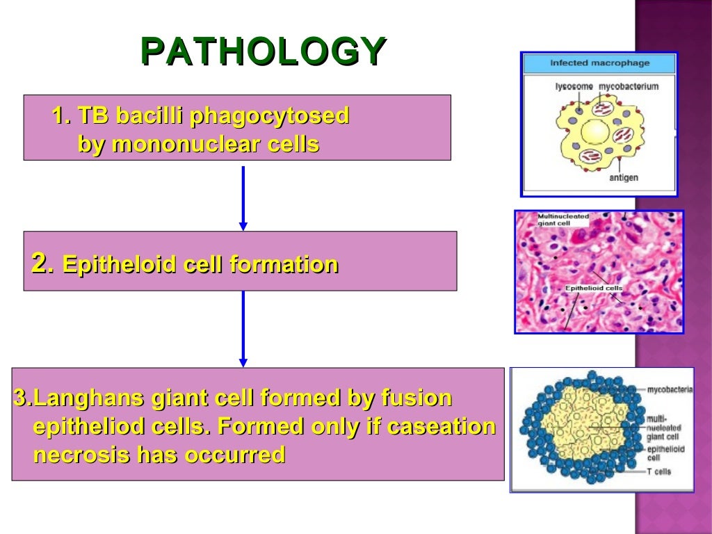 Tuberculosis Of Spine