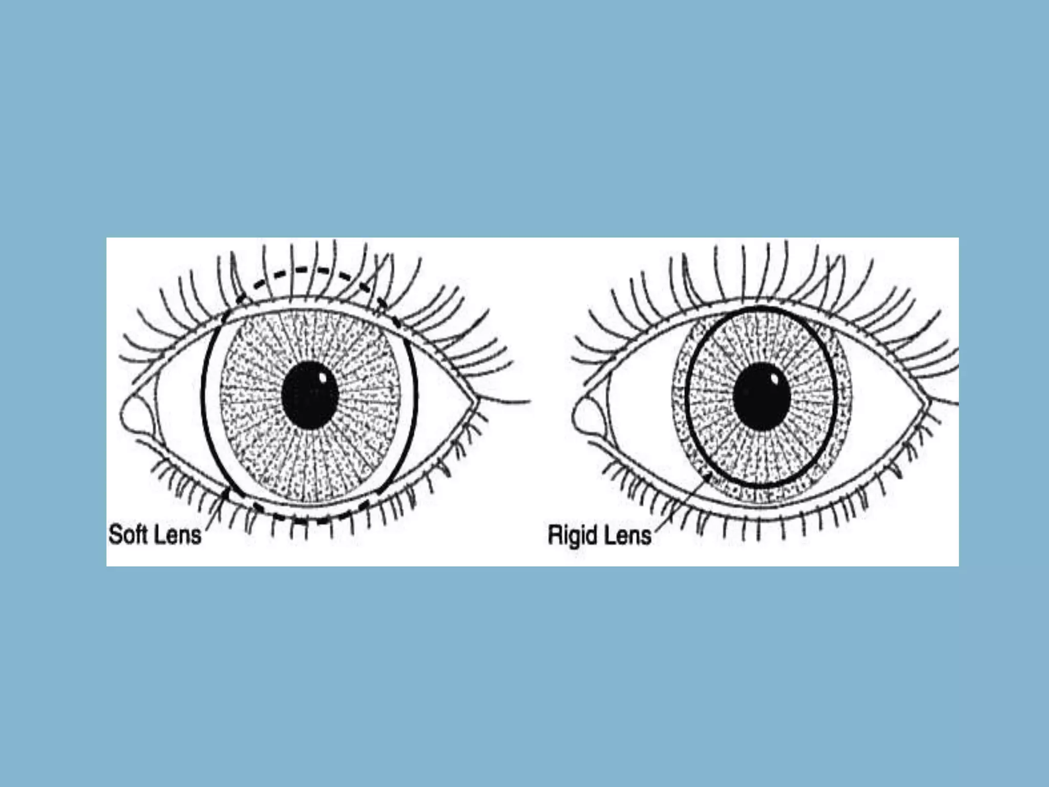 Hardlens softlens | PPT