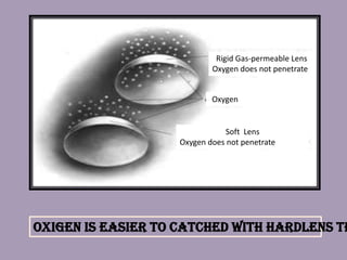 Hardlens softlens | PPT