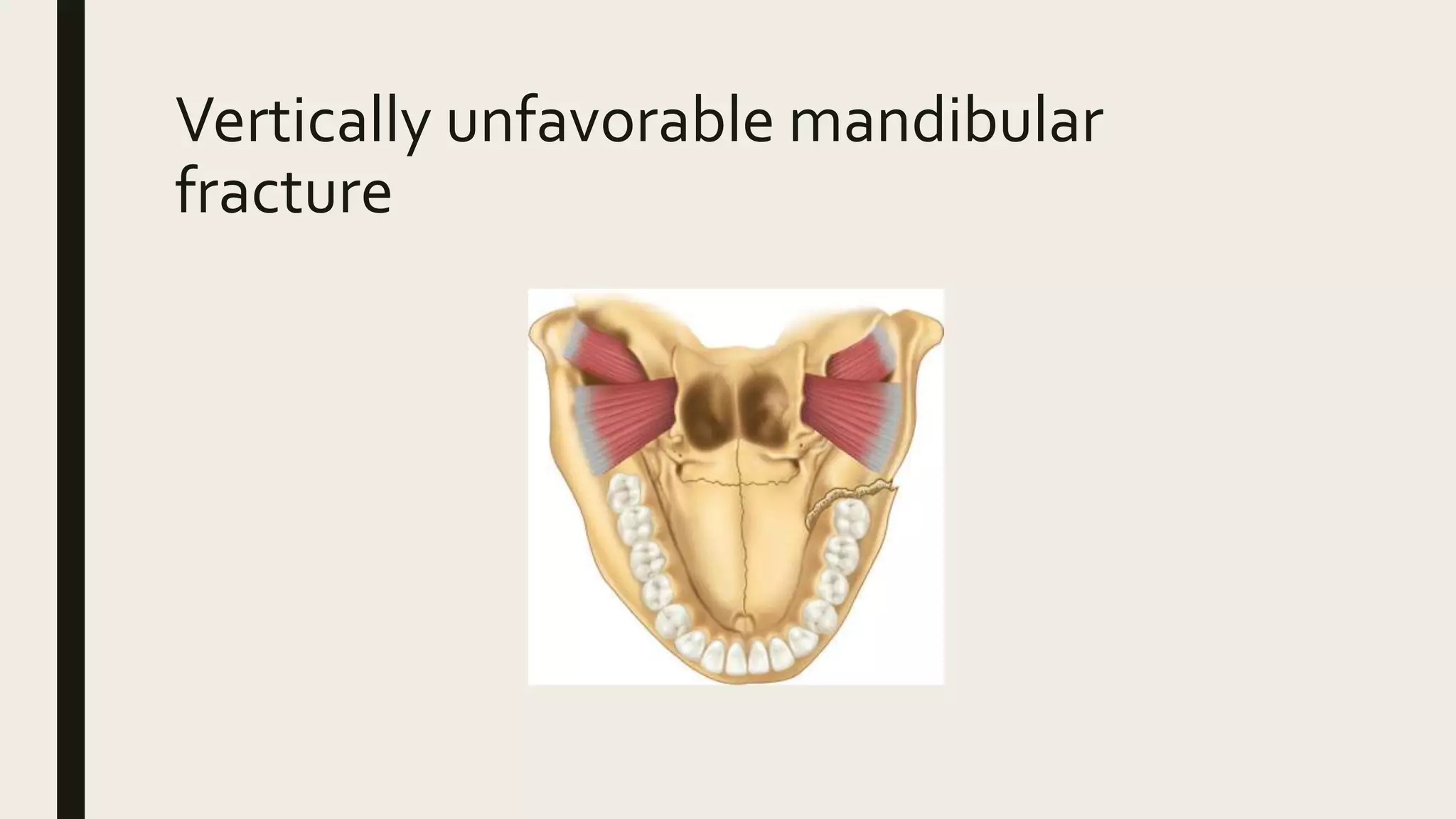 Hard tissue trauma in maxillofacial surgery without voice | PPTX