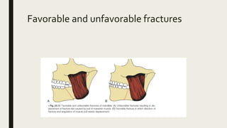 Hard tissue trauma in maxillofacial surgery without voice | PPTX