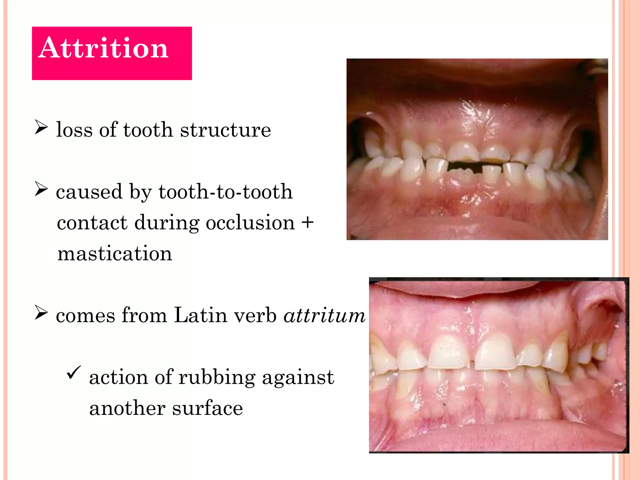 Hard Tooth Tissue Reduction | PPT