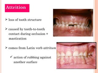 Hard Tooth Tissue Reduction | PPT