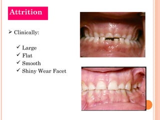 Hard Tooth Tissue Reduction | PPT