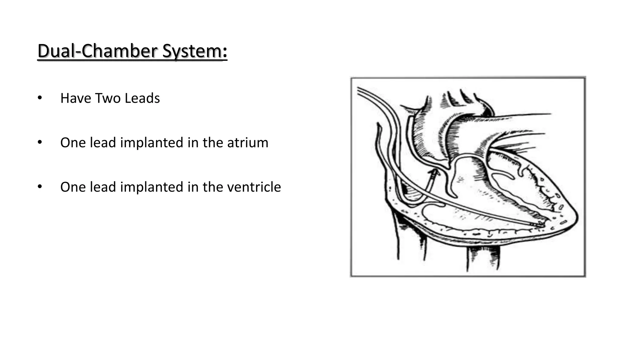 Components of Pacemaker and ICDs - understanding the hardware | PPTX ...