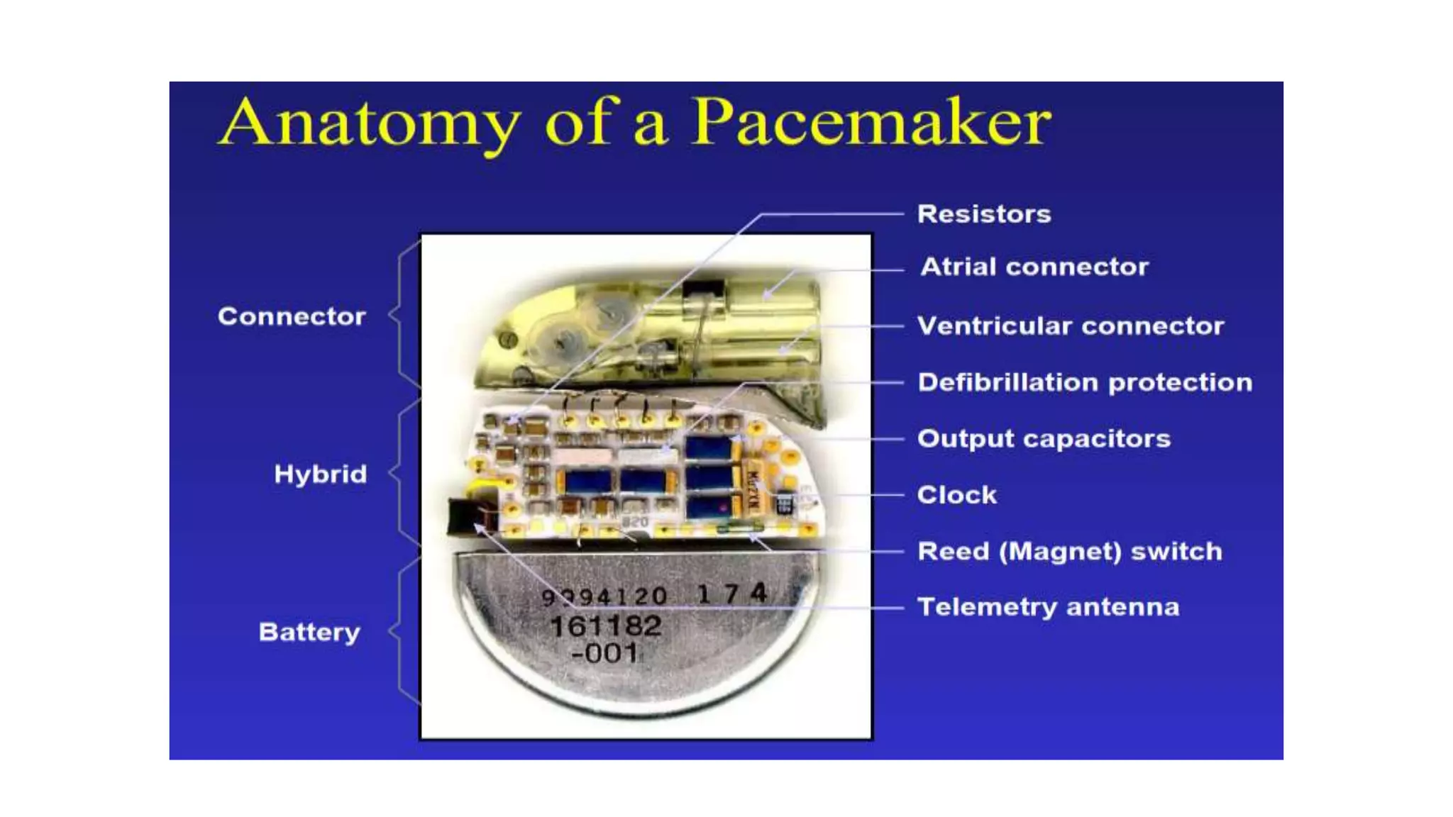 Components of Pacemaker and ICDs - understanding the hardware | PPTX ...