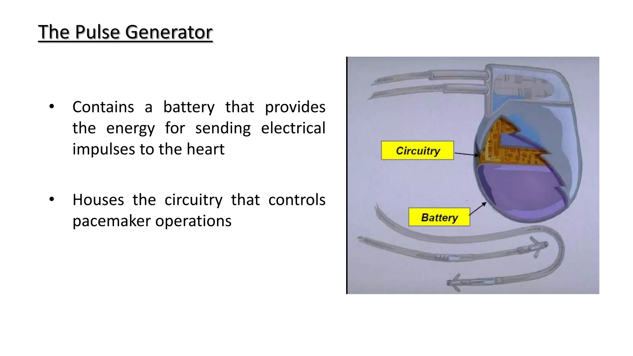 Components of Pacemaker and ICDs - understanding the hardware | PPTX ...