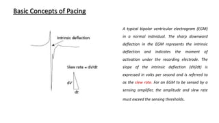 Components of Pacemaker and ICDs - understanding the hardware | PPTX