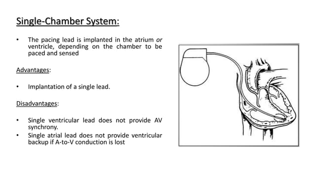 Components of Pacemaker and ICDs - understanding the hardware | PPTX ...