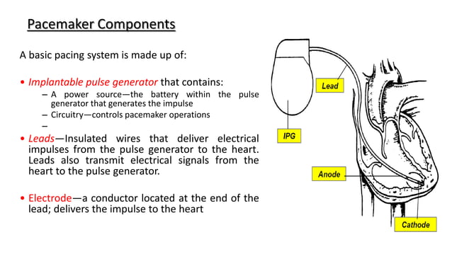 Components of Pacemaker and ICDs - understanding the hardware | PPTX ...