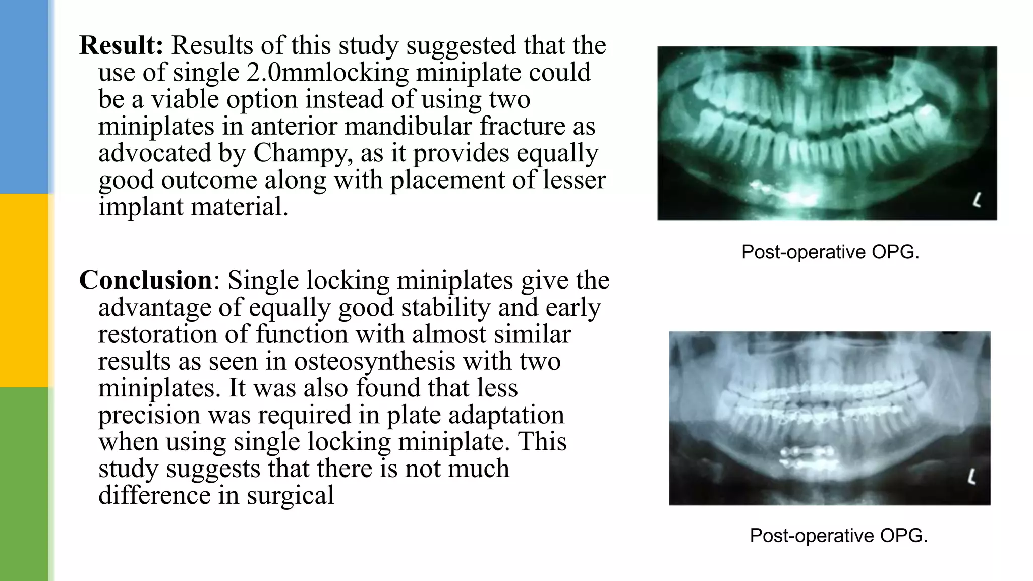 Hardware in maxillofacial trauma | PPTX