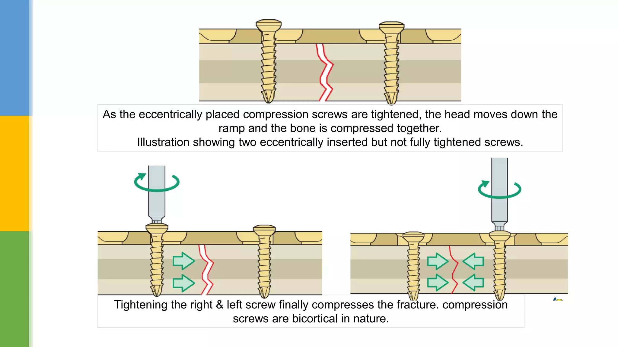 Hardware in maxillofacial trauma | PPTX