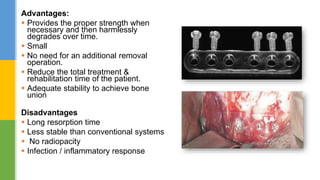 Hardware in maxillofacial trauma | PPTX