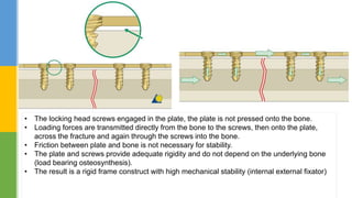 Hardware in maxillofacial trauma | PPTX