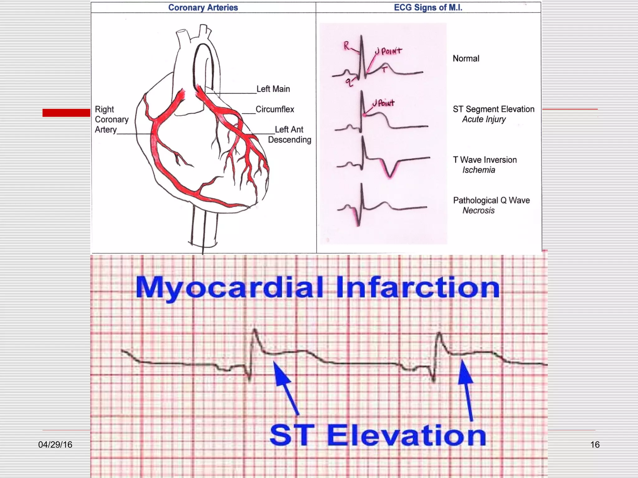 myocardial infaction etiology and pathogenisis by Dr Harikrishna S | PPT