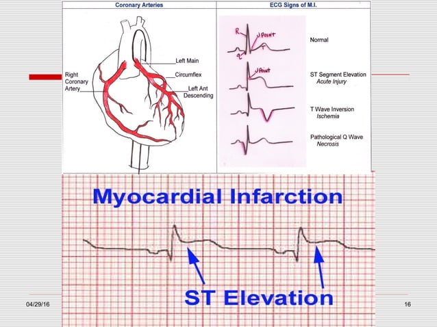 myocardial infaction etiology and pathogenisis by Dr Harikrishna S | PPT