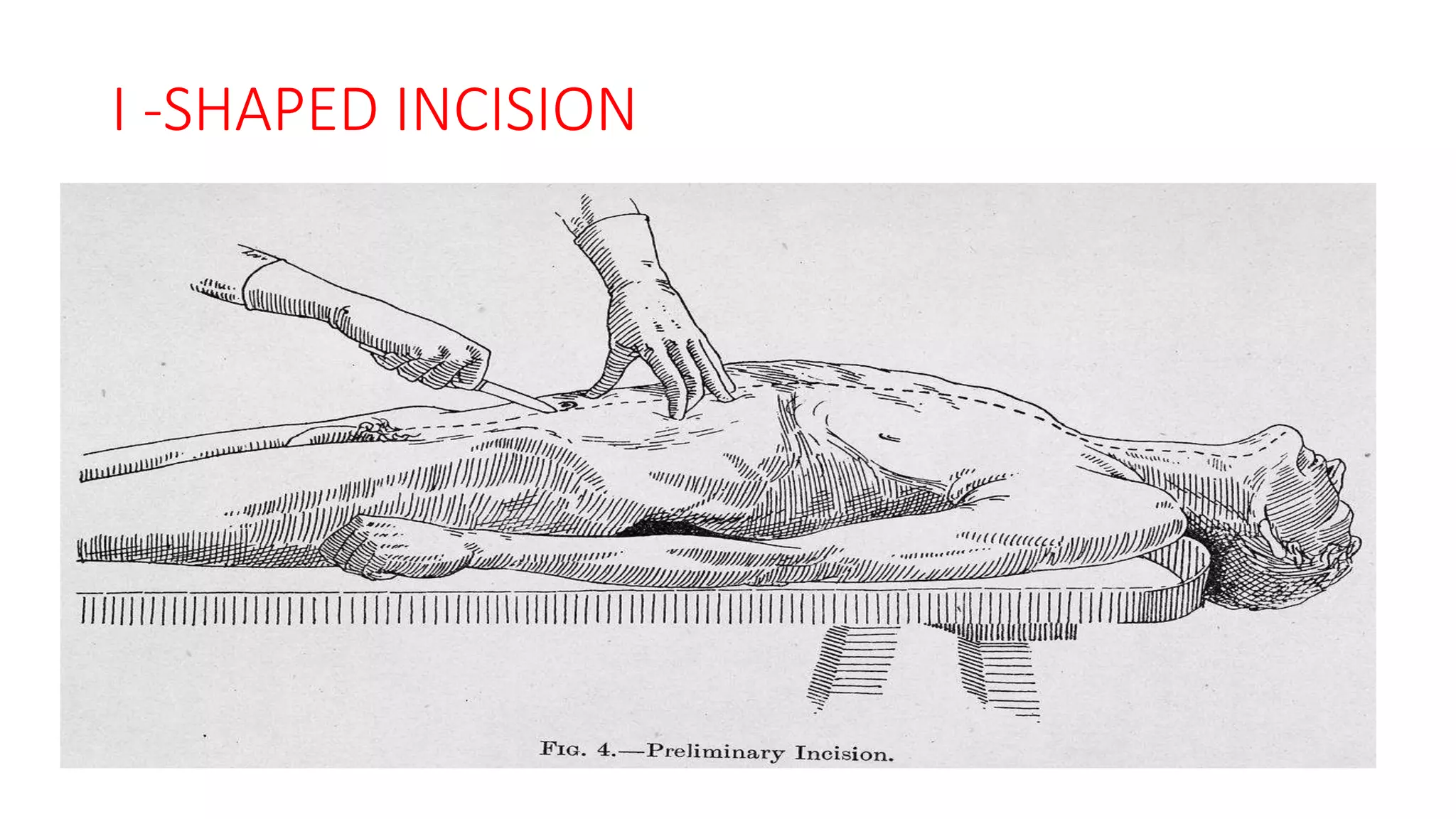 Presentation autopsy incisions-.pptx. Dr. Haricharan MD RIMS Imphal ...