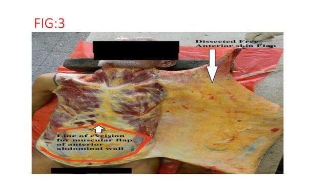 Presentation autopsy incisions-.pptx. Dr. Haricharan MD RIMS Imphal ...