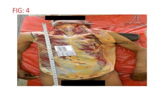 Presentation autopsy incisions-.pptx. Dr. Haricharan MD RIMS Imphal ...