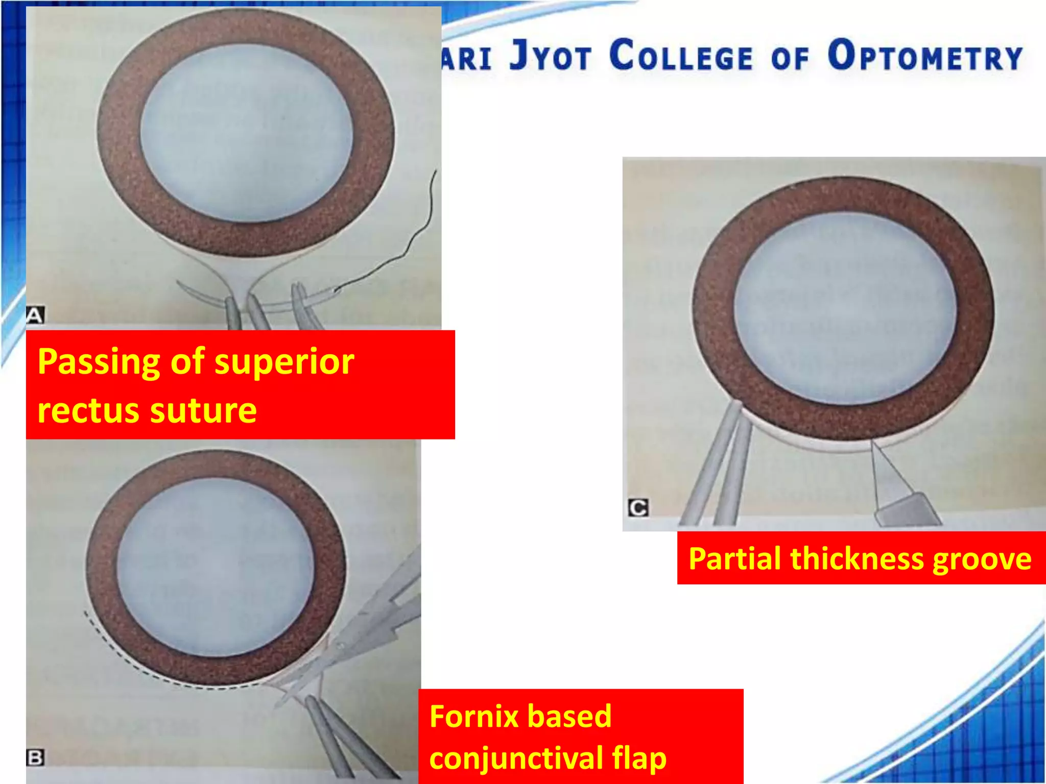 Intracapsular Cataract extraction | PPTX