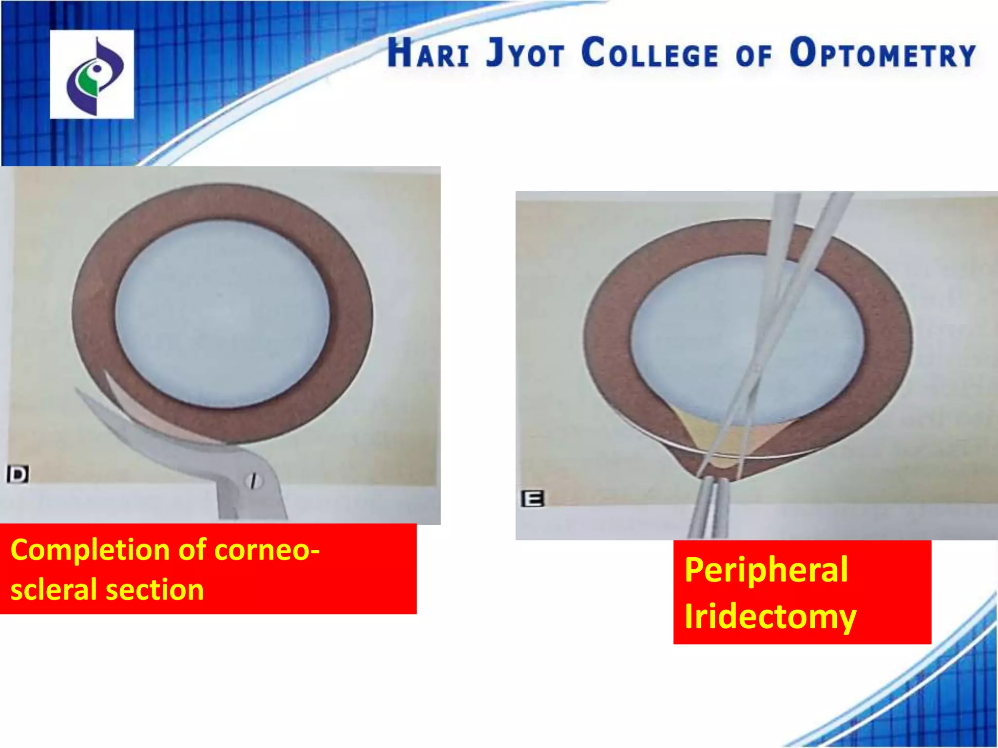 Intracapsular Cataract extraction | PPTX