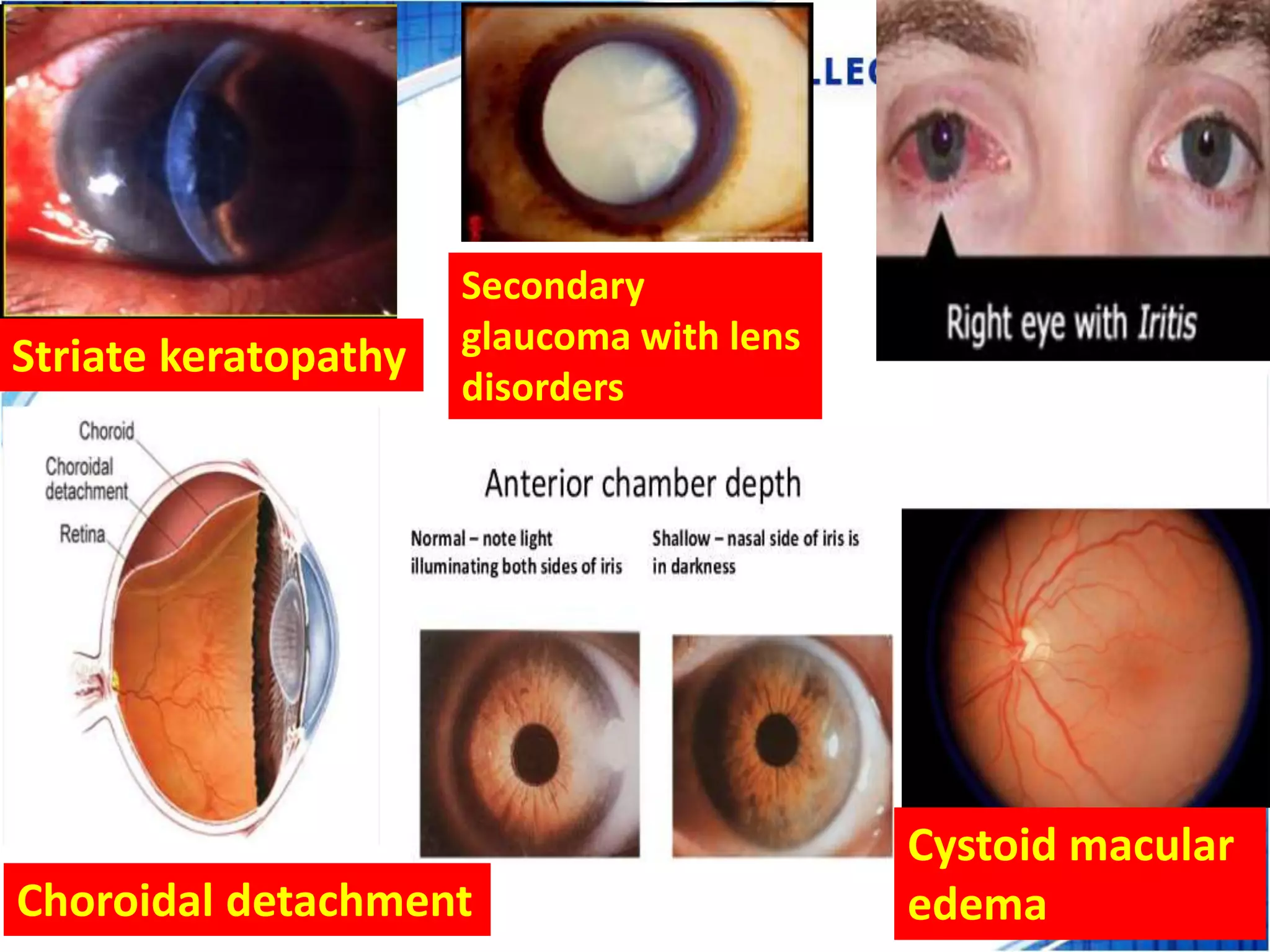 Intracapsular Cataract extraction | PPTX