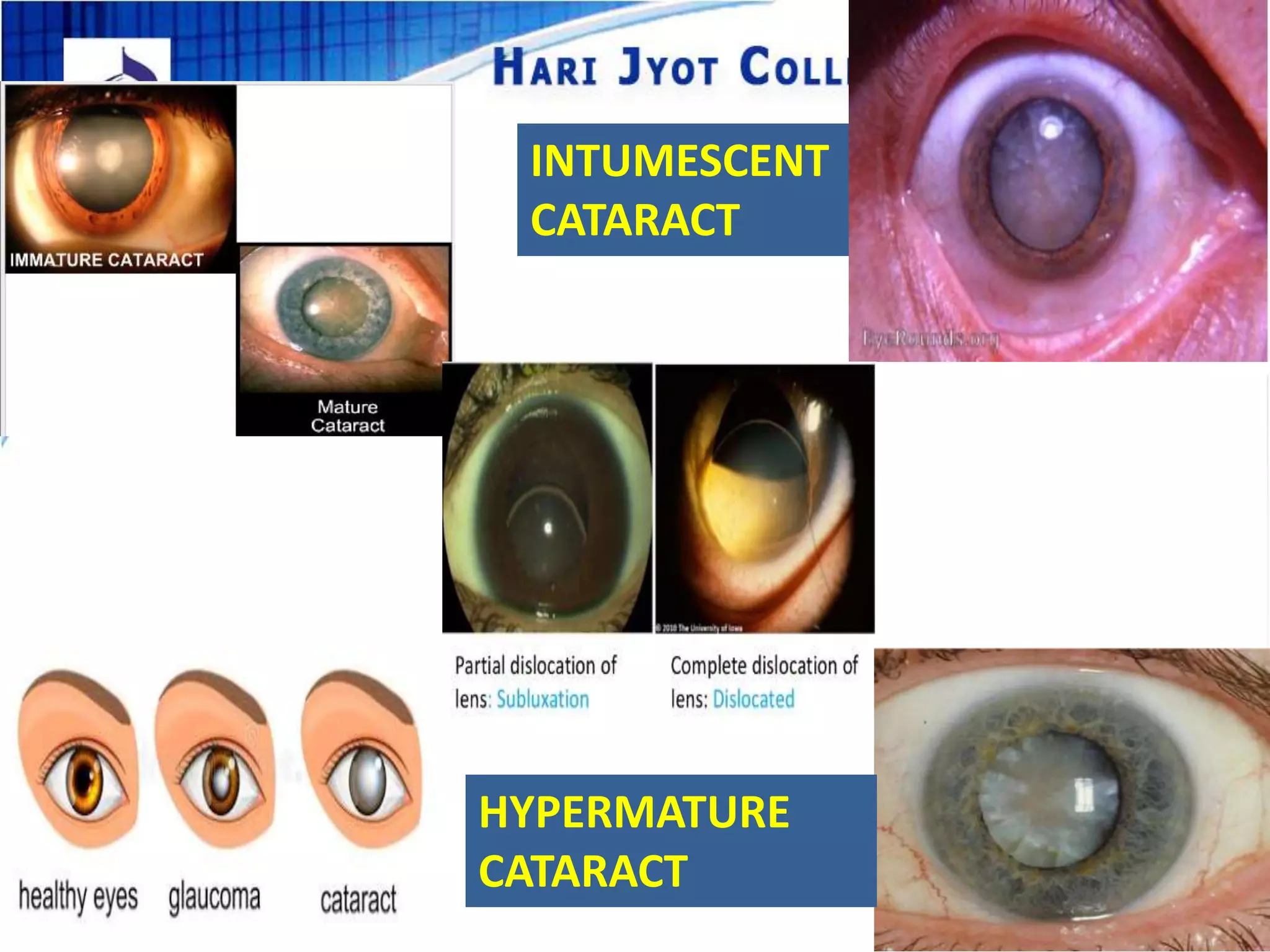 Intracapsular Cataract extraction | PPTX