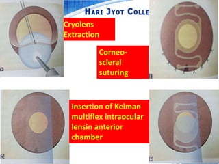 Intracapsular Cataract extraction | PPTX