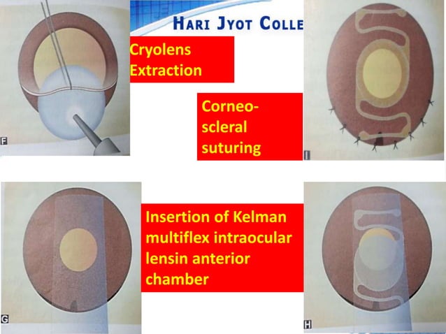Intracapsular Cataract extraction | PPTX
