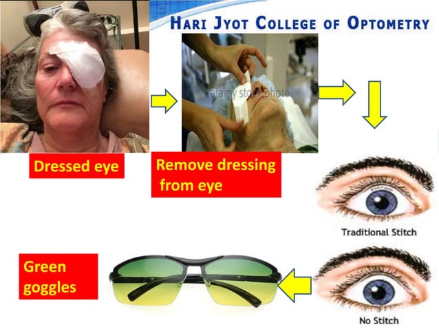 Intracapsular Cataract extraction | PPTX