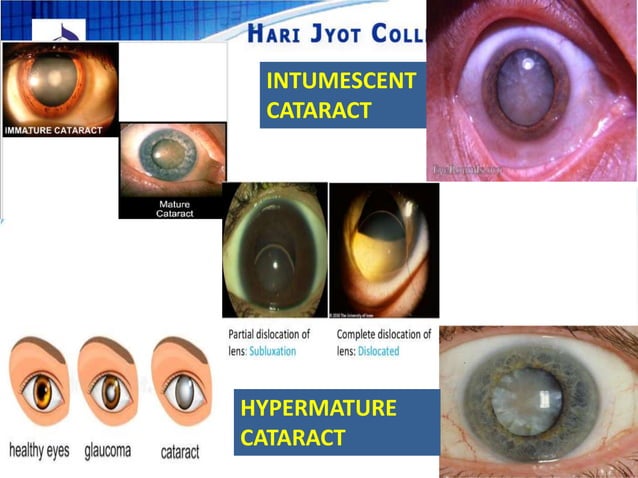 Intracapsular Cataract extraction | PPTX