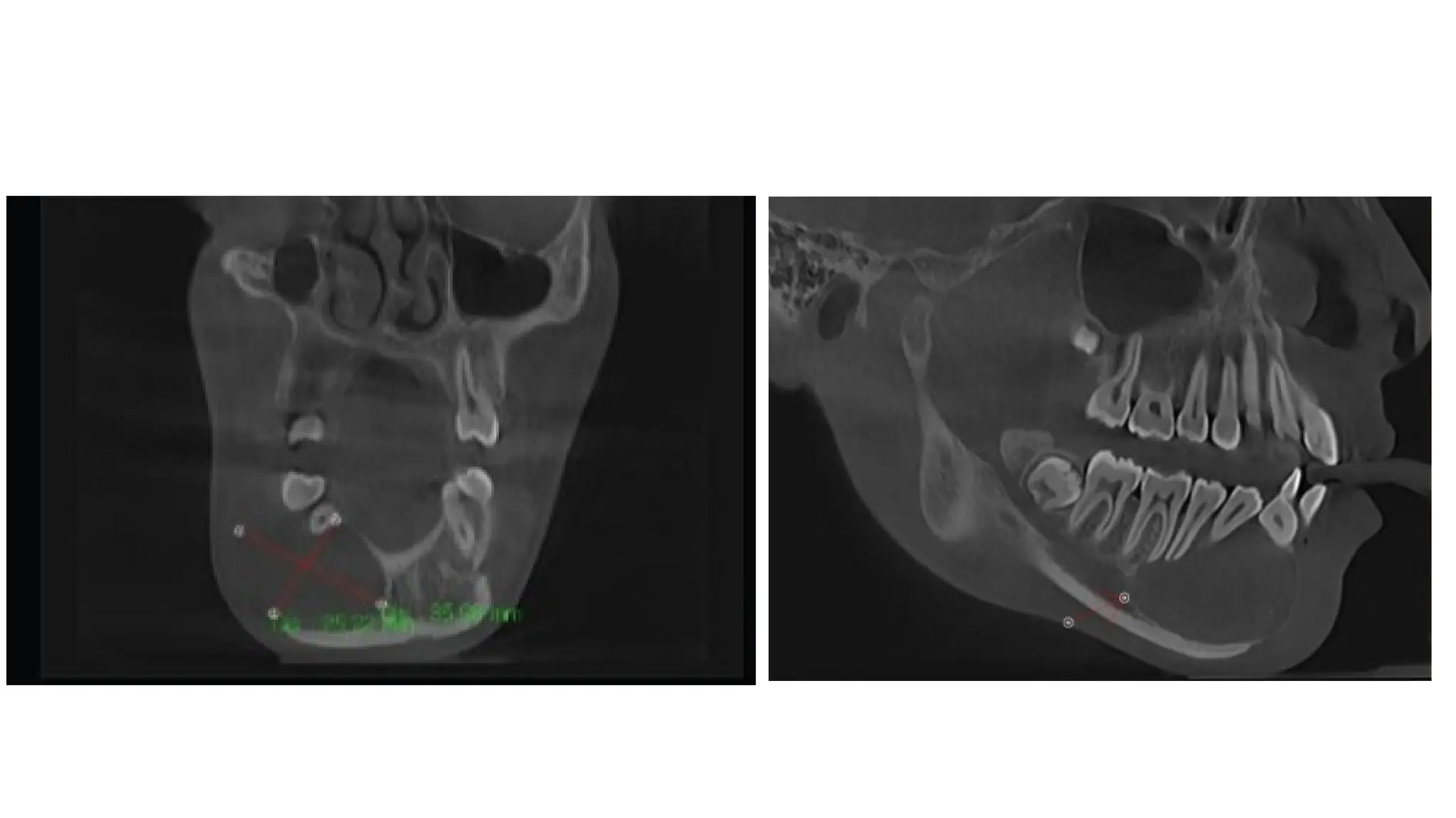 Calcified odontogenic tunor of the mandible | PPTX