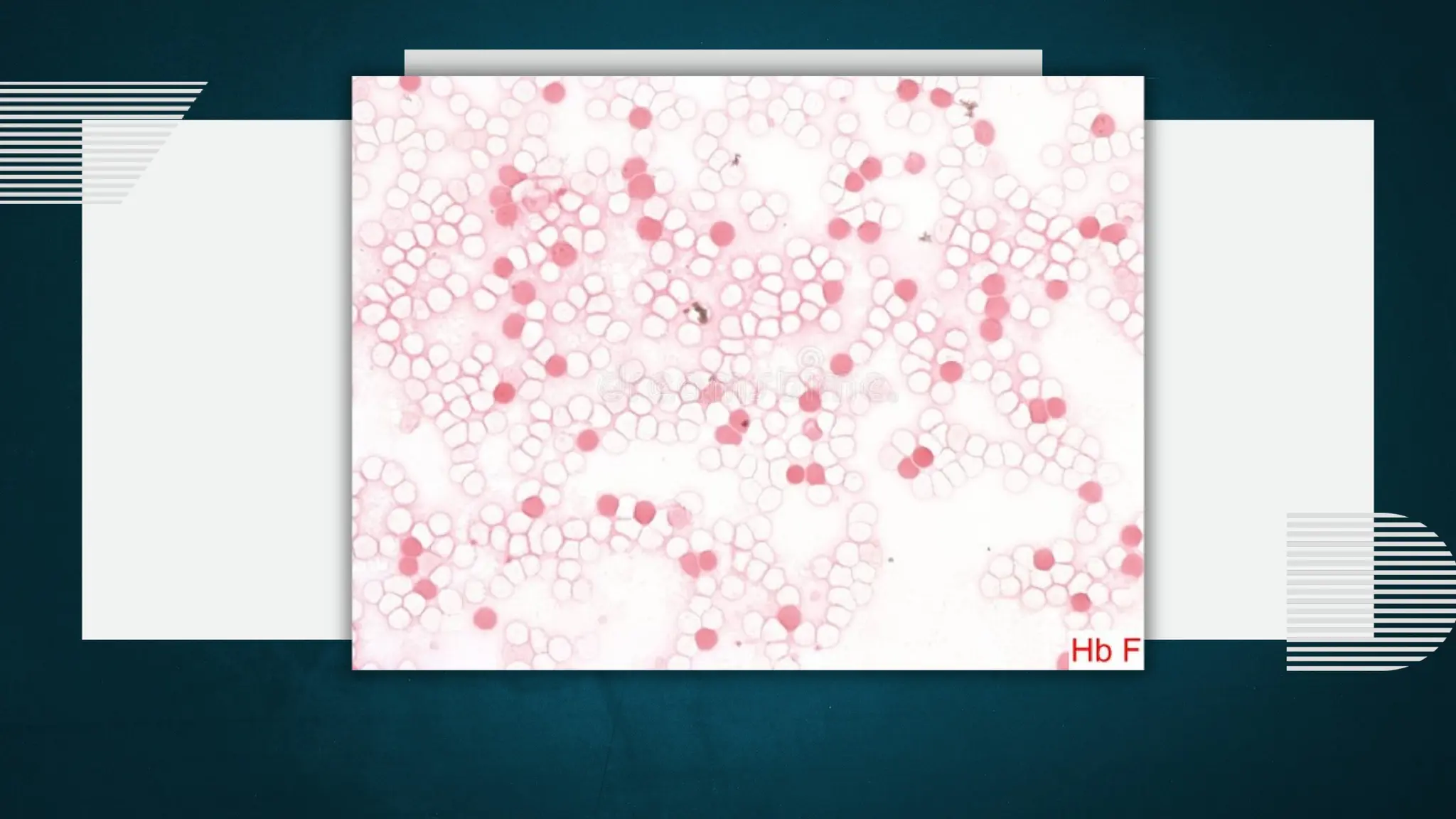 Haemoglobin F stain (acid elution)(kleihauer Betke test) | PPTX