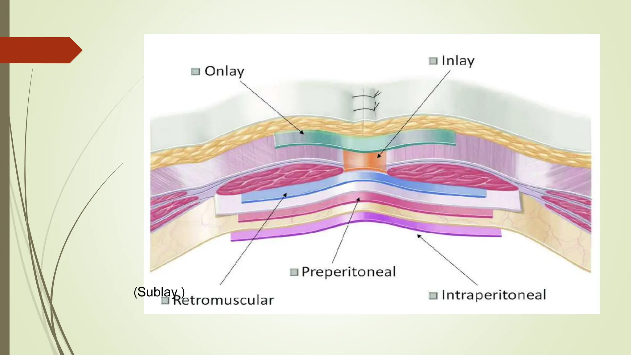 Ventral hernia Update and Journal Club.pptx