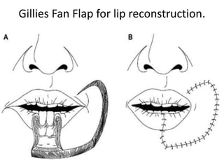 Harold gillies | PPT
