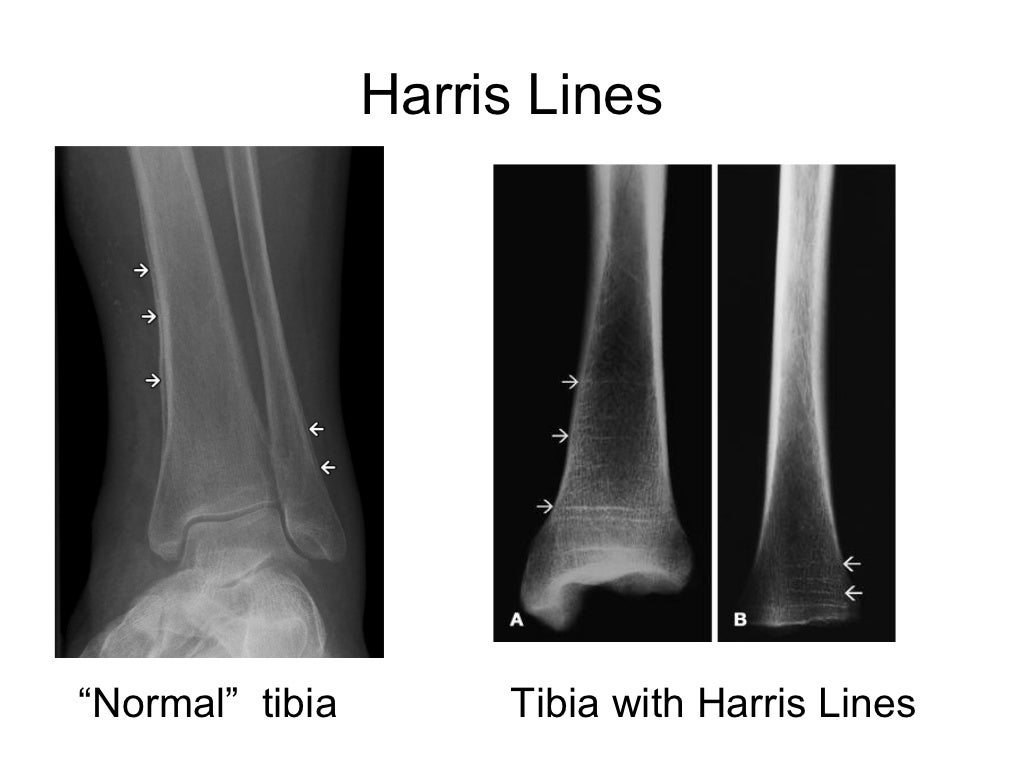 Session no. 2, 2010: Harris Lines & Linear Enamel Hypoplasia, by Susan ...