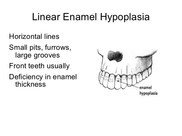 Session no. 2, 2010: Harris Lines & Linear Enamel Hypoplasia, by…