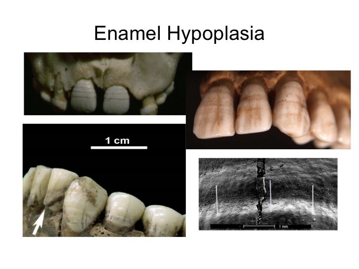Session no. 2, 2010: Harris Lines & Linear Enamel Hypoplasia, by…