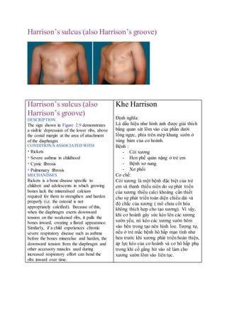 Harrison sulcus | DOCX