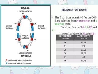 Oral hygiene index simplified pptttttpdf | PDF