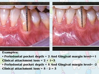Oral hygiene index simplified pptttttpdf | PPT